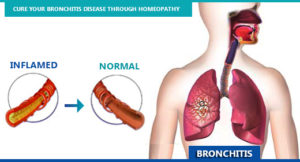 Homeopathy treatment for Bronchitis that works effectively